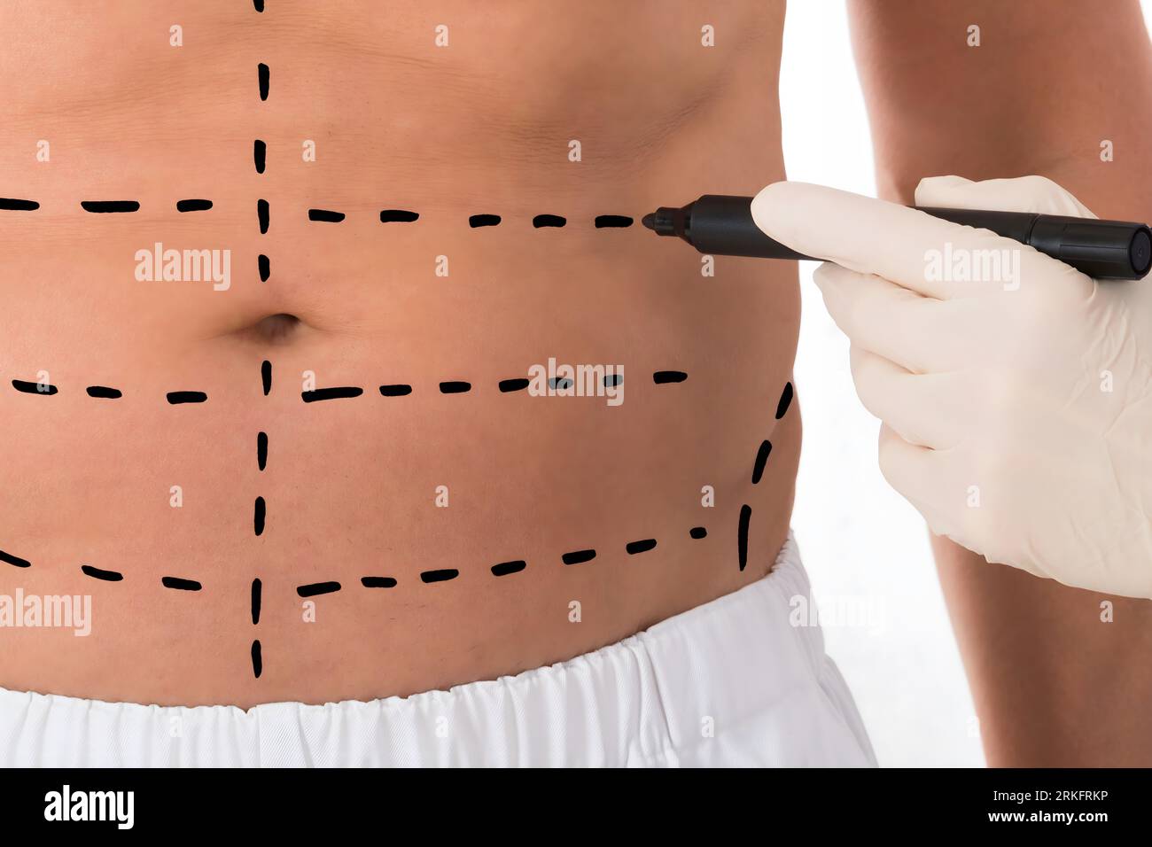 Surgical tummy tuck hi-res stock photography and images - Alamy