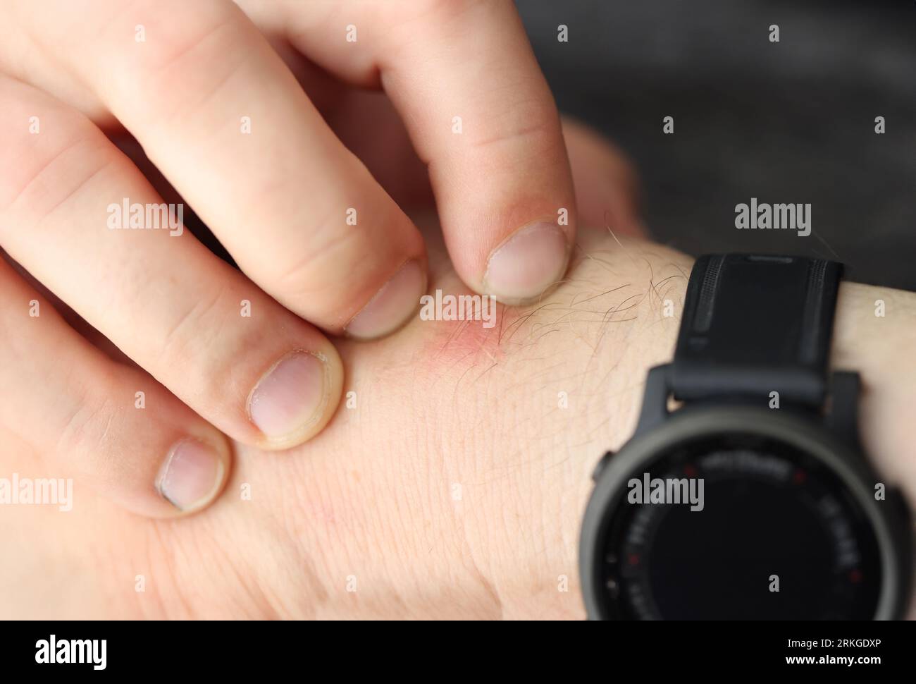 Man scratches red spot on wrist closeup Stock Photo - Alamy