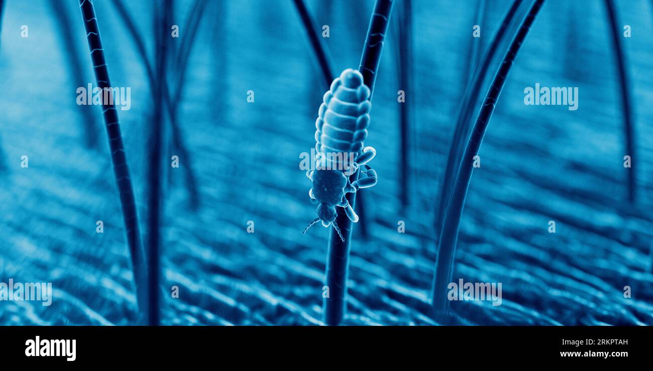 Head louse, illustration Stock Photo - Alamy