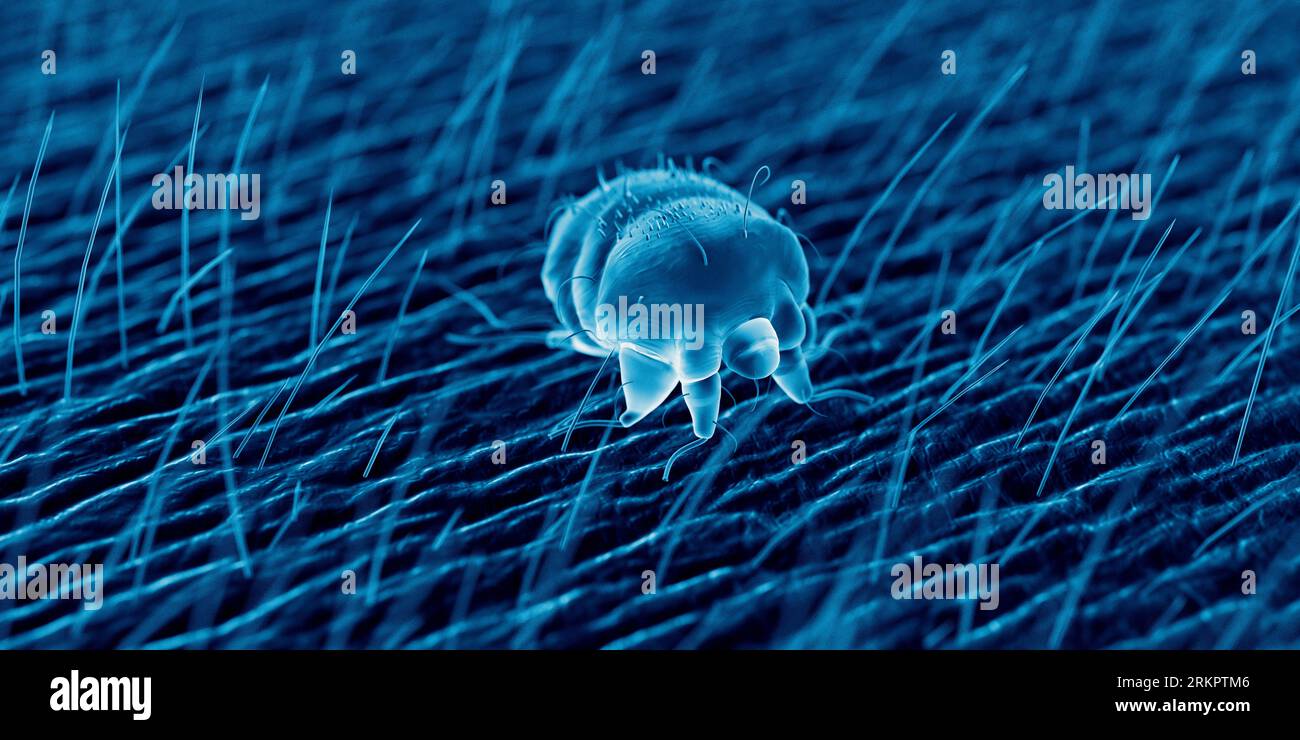 Scabies mite on human skin, illustration Stock Photo - Alamy
