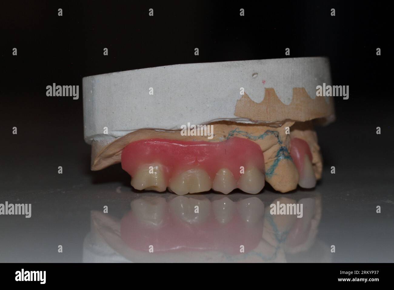 dental technician model removable prosthesis PAPM cobalt chrome resin ...