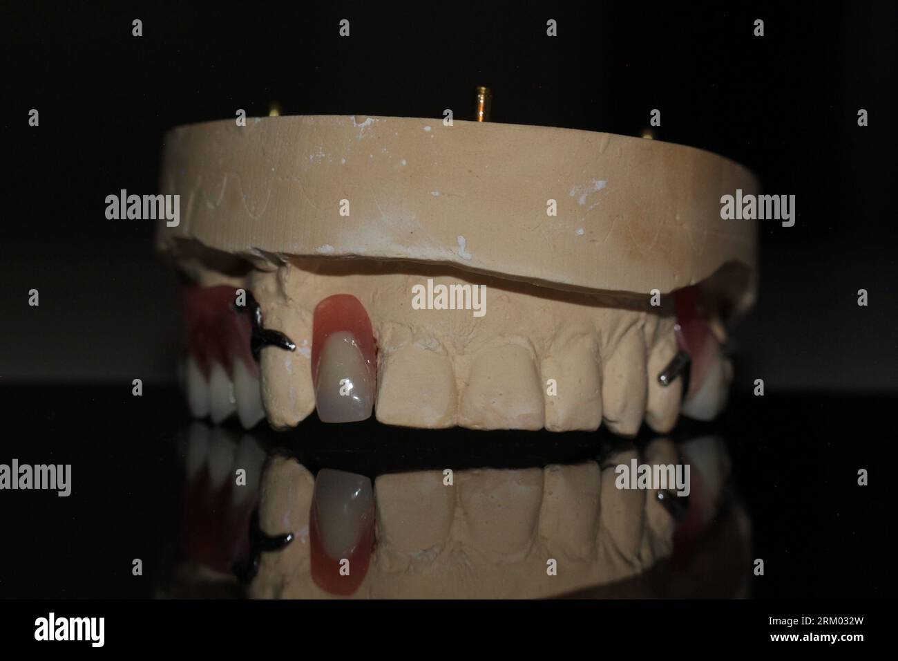 dental technician model removable prosthesis PAPM cobalt chrome resin ...