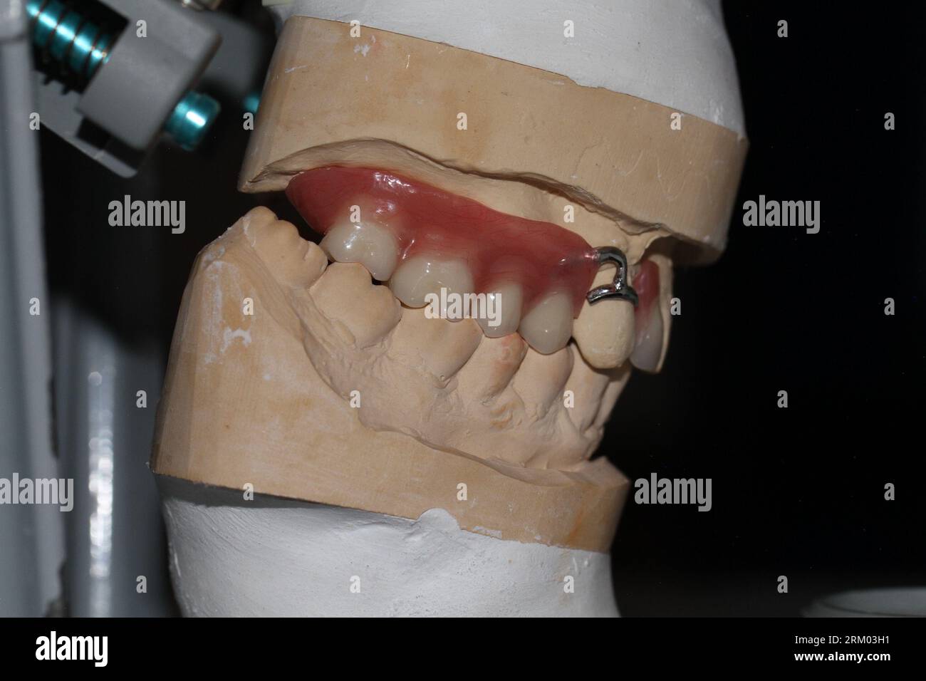 dental technician model removable prosthesis PAPM cobalt chrome resin ...
