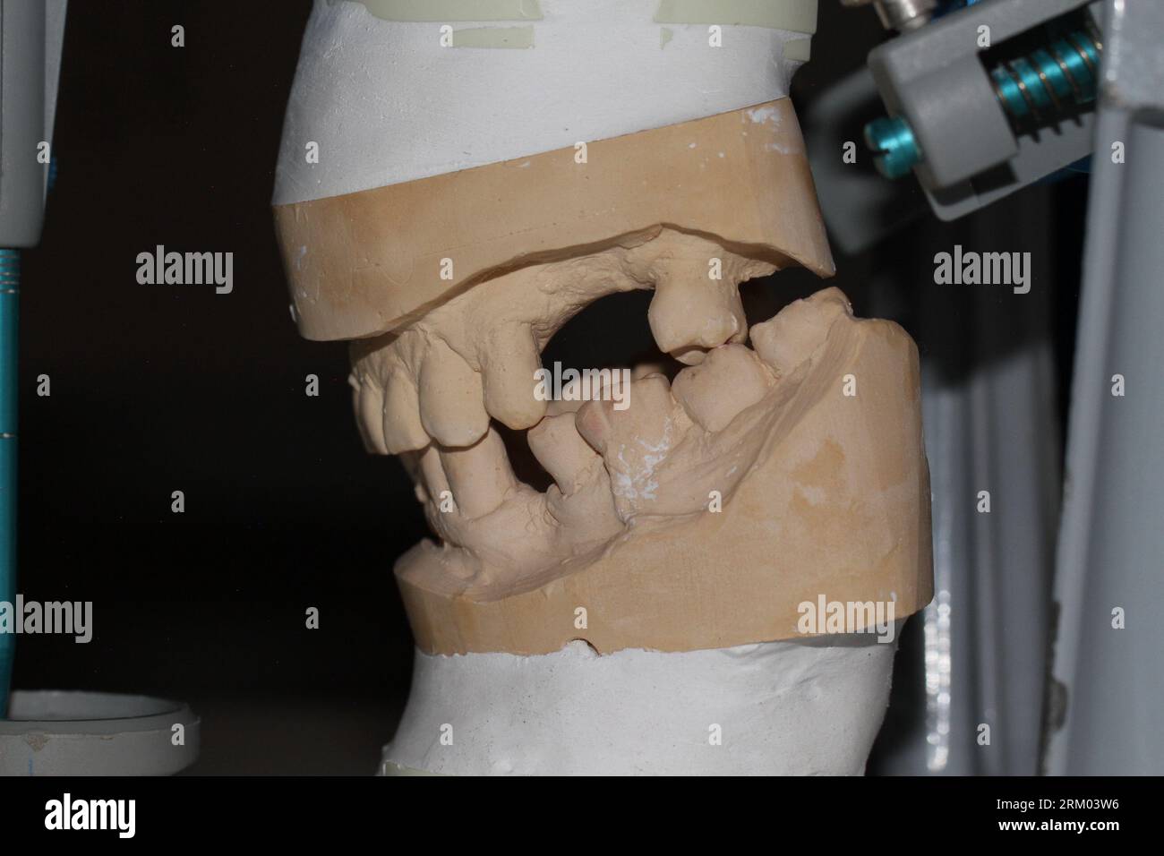 dental technician model removable prosthesis PAPM cobalt chrome resin ...