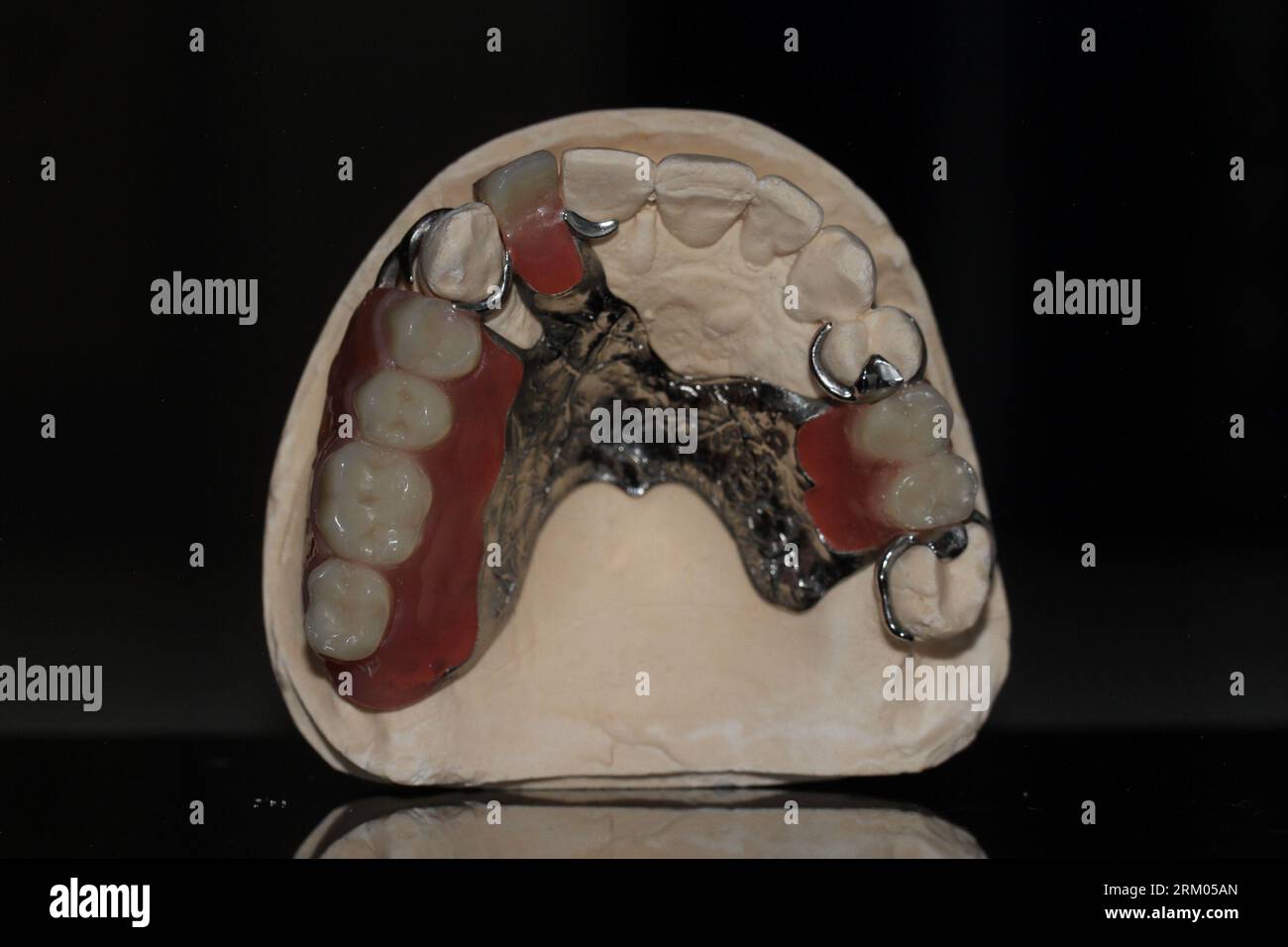 dental technician model removable prosthesis PAPM cobalt chrome resin ...
