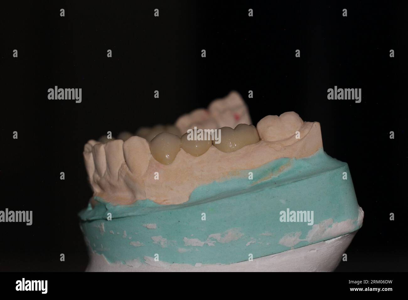 dental technician model fixed prosthesis ceramic wax up plaster crown ...