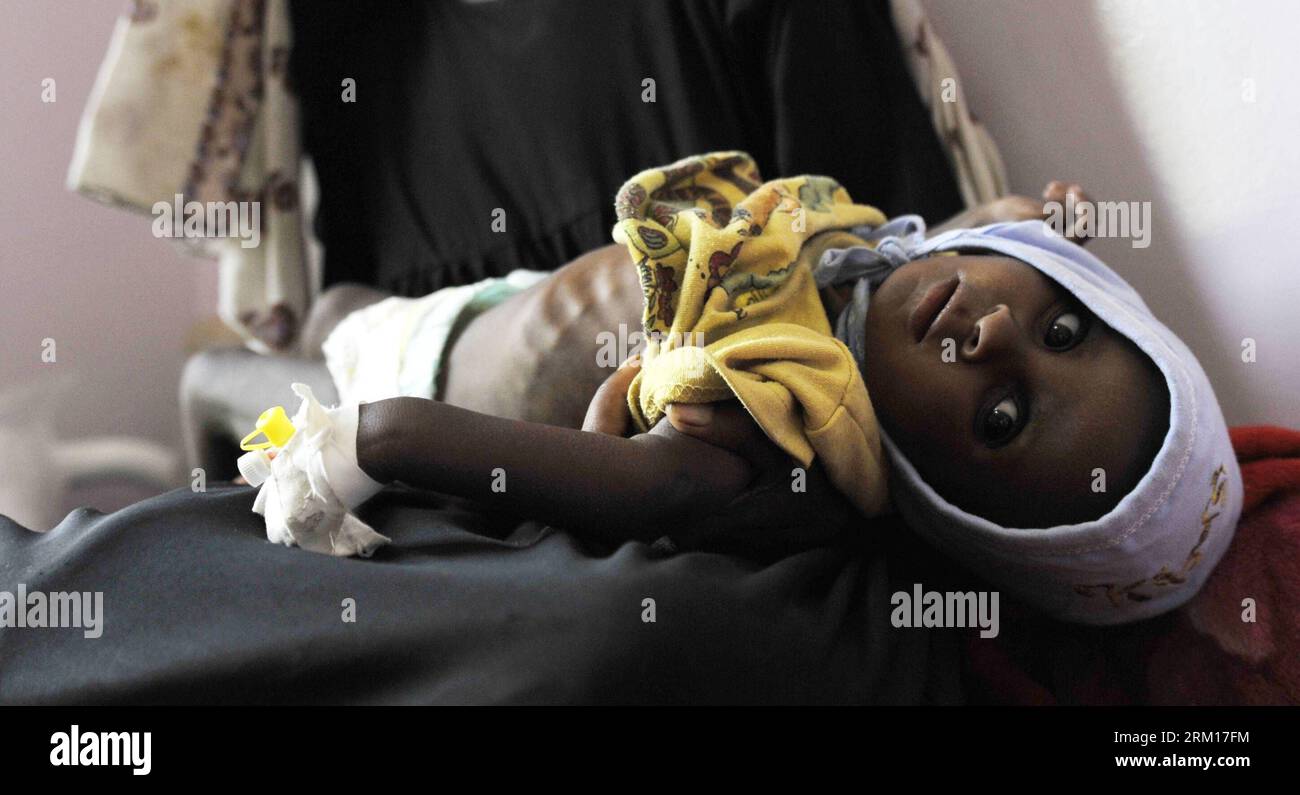 Chronic malnutrition hi-res stock photography and images - Alamy