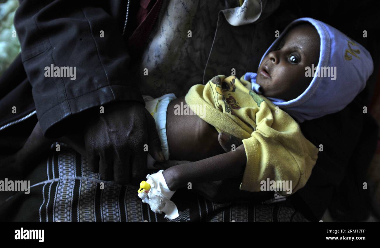 Chronic malnutrition hi-res stock photography and images - Alamy