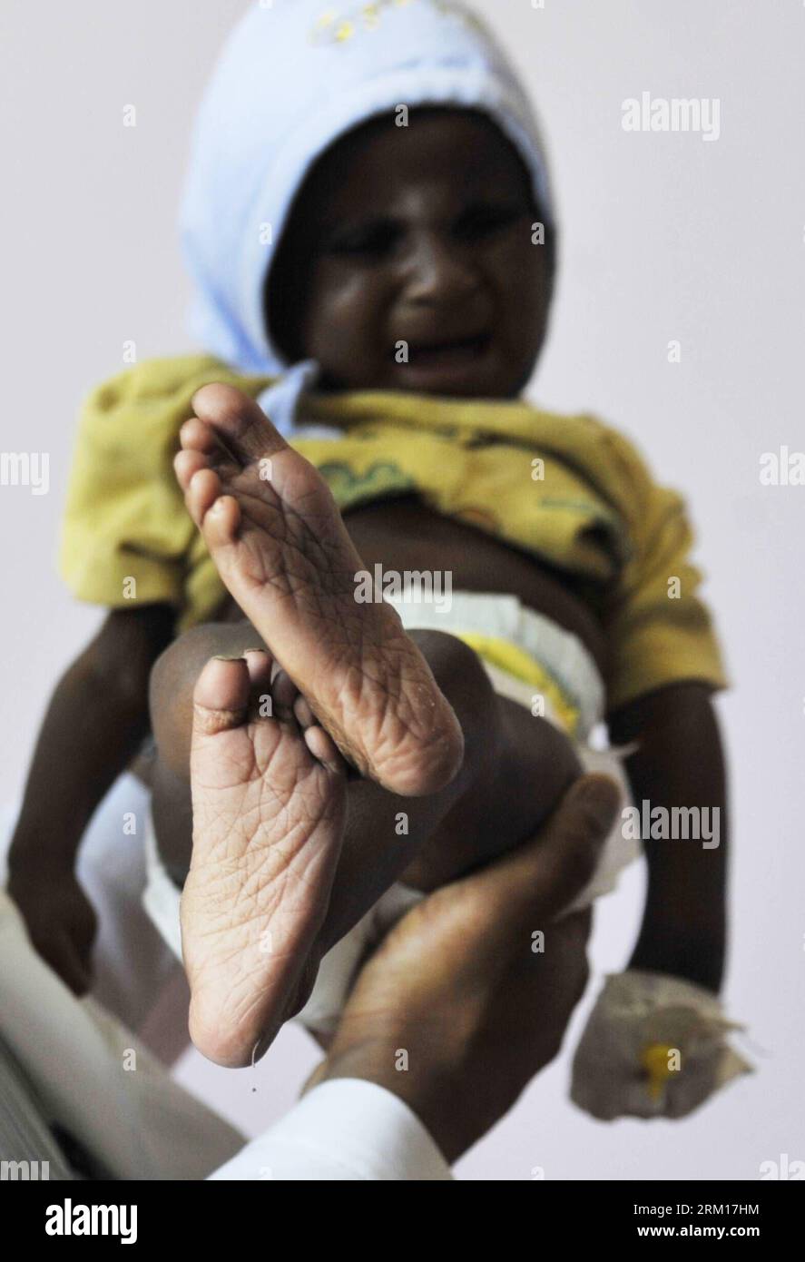 Stunted children hi-res stock photography and images - Alamy