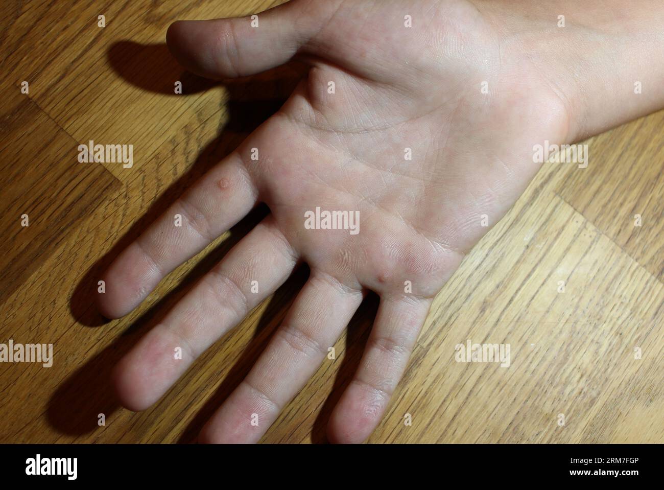 Warts Verrucas on the Hand Stock Photo - Alamy