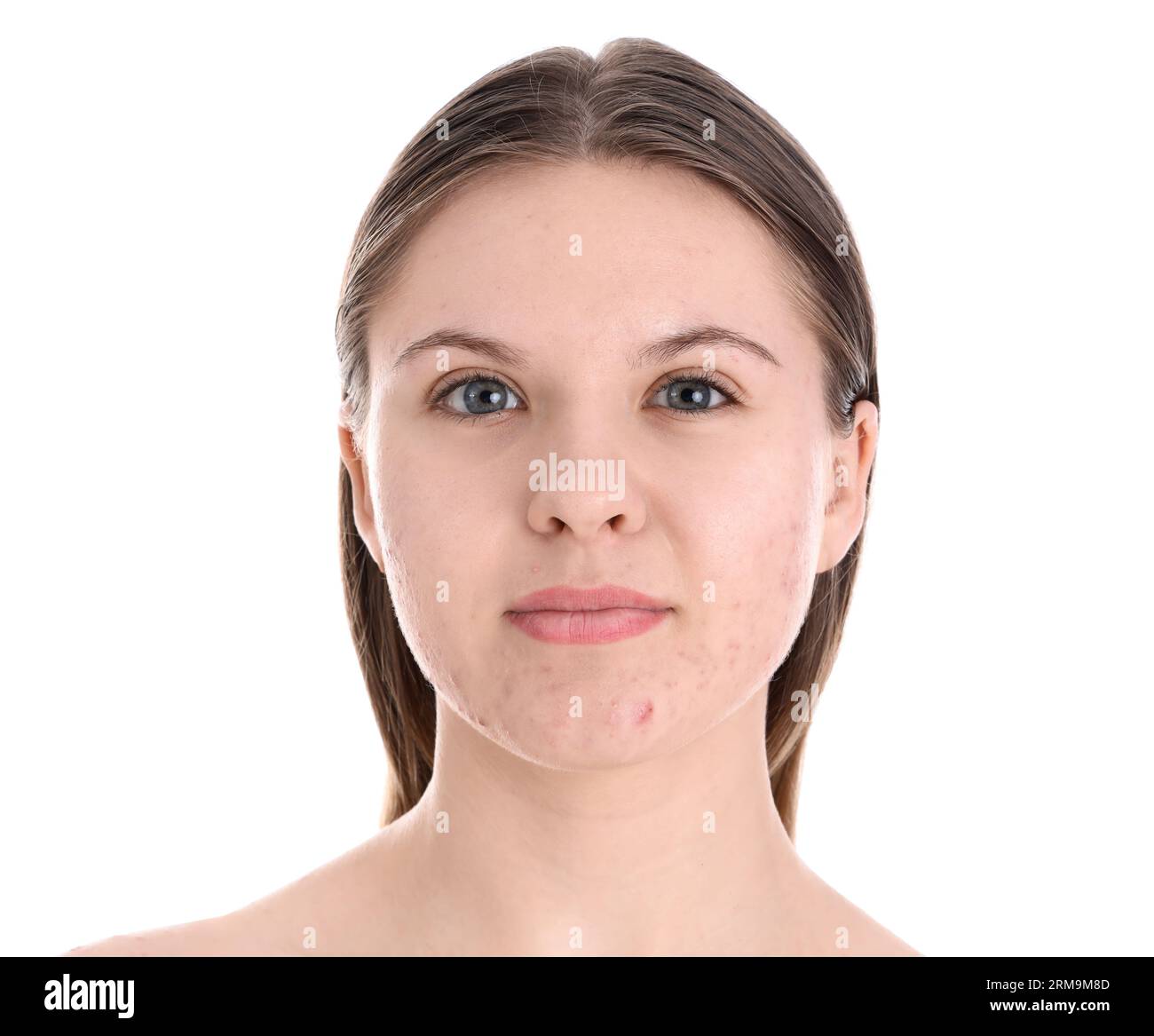 Teenage girl with acne problem on white background, closeup Stock Photo ...