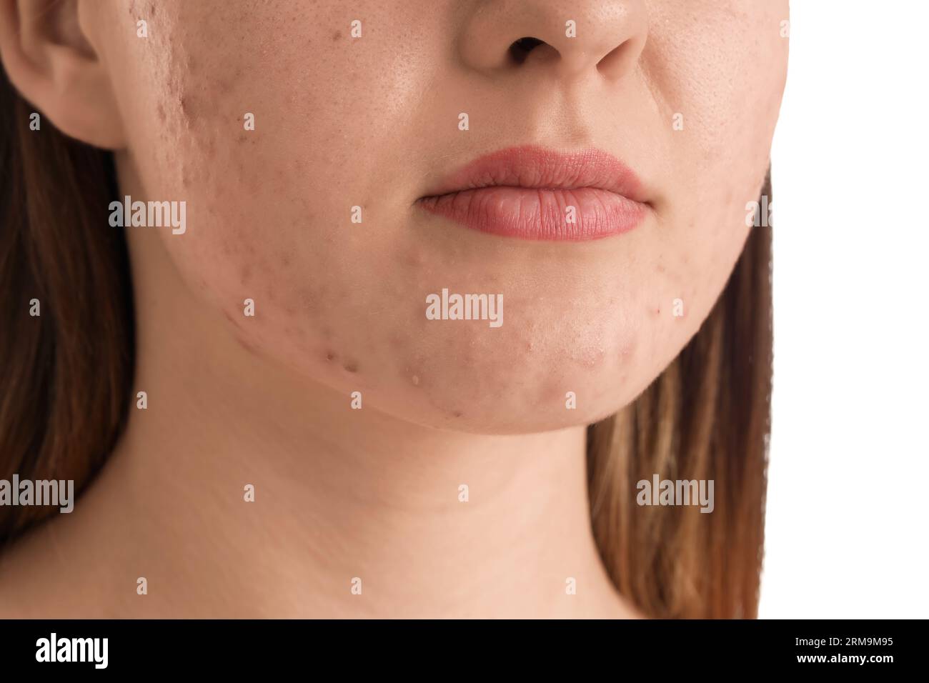 Teenage girl with acne problem on white background, closeup Stock Photo ...