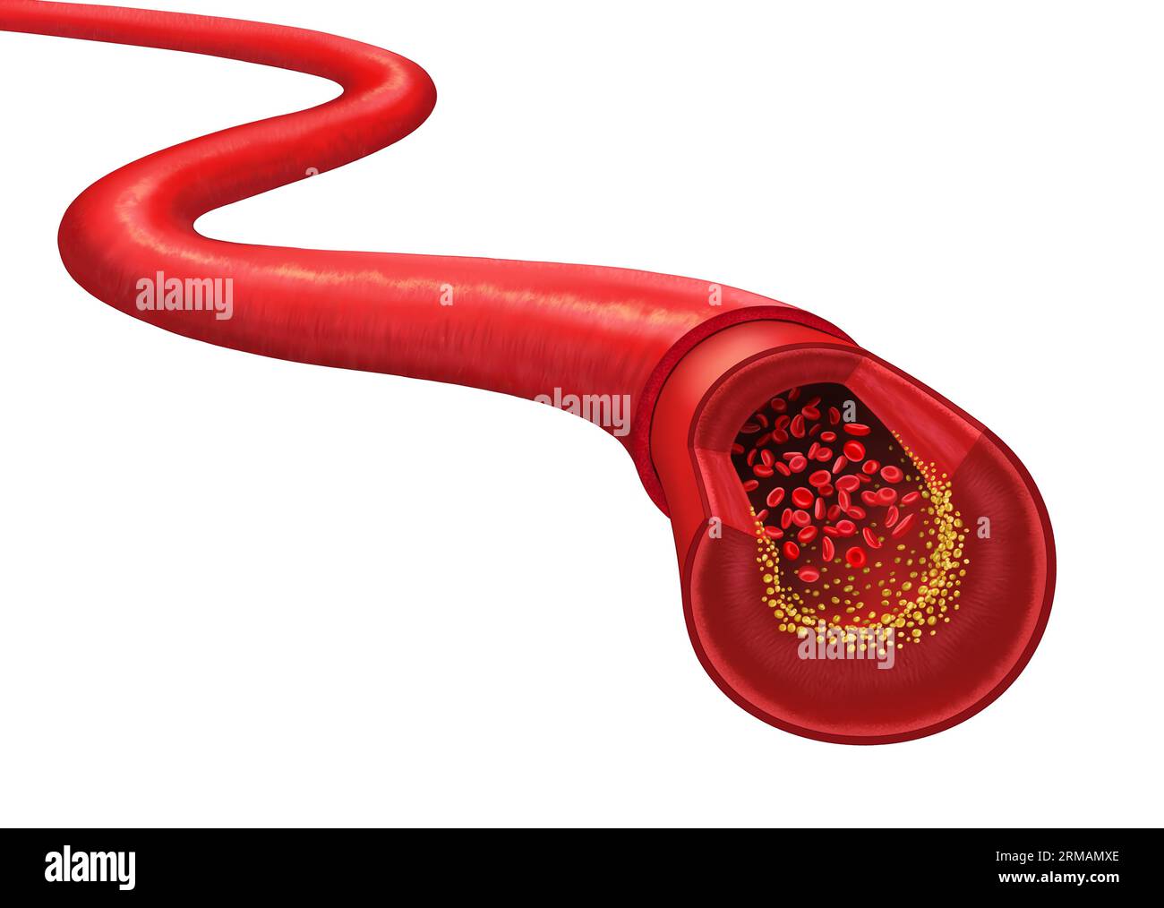 an illustration of a vascular dissection Stock Photo - Alamy