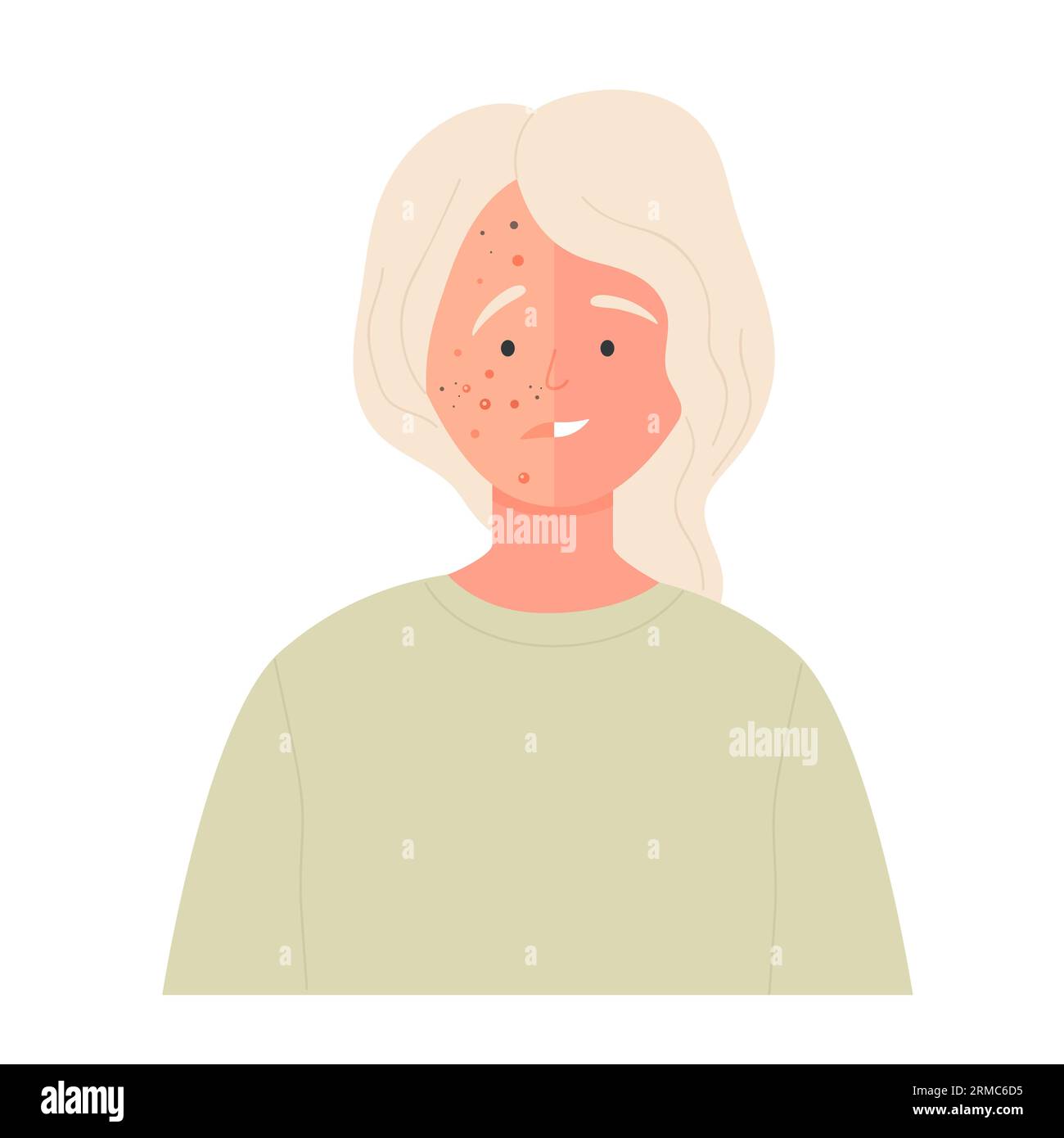 Acne face before and after treatment. Sad girl with dermis problems and ...