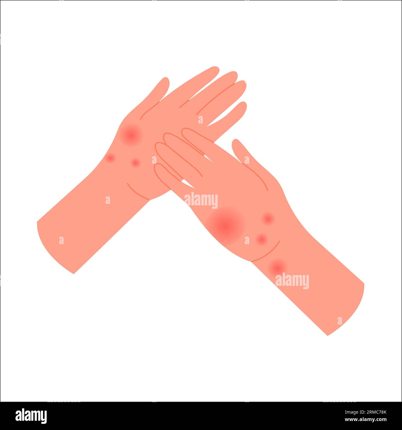 Human hands with allergic reaction. Hands covered with red itchy rash ...