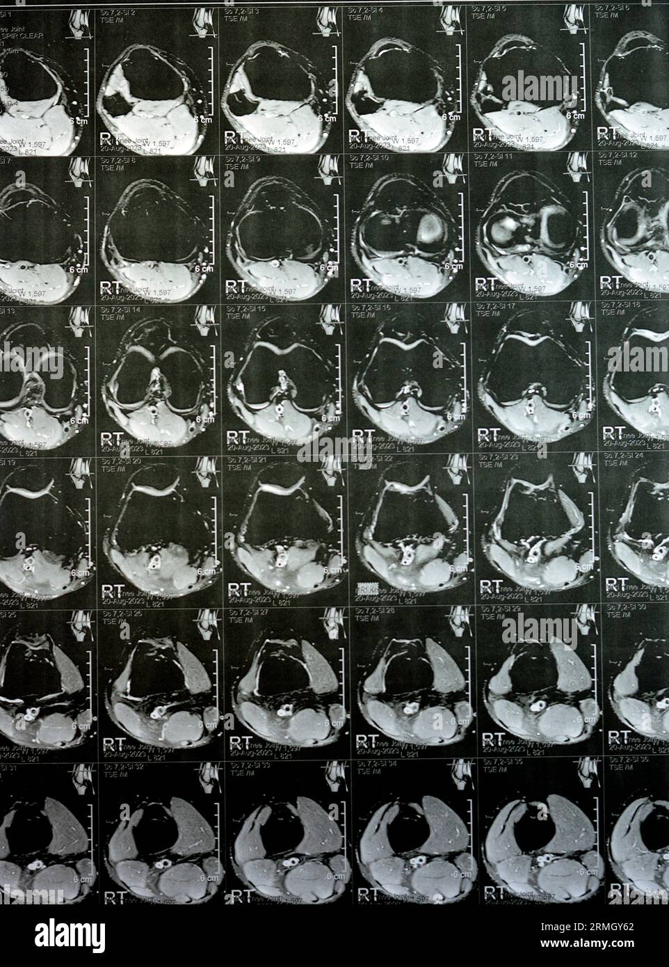 MRI of the right knee showing mild joint effusion, with normal other ...