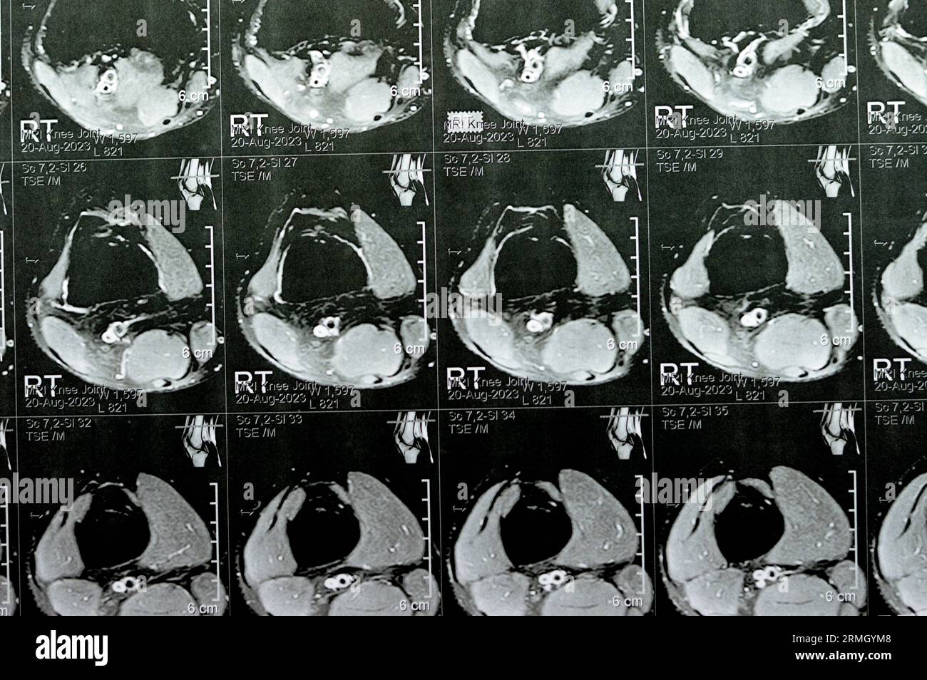MRI of the right knee showing mild joint effusion, with normal other ...