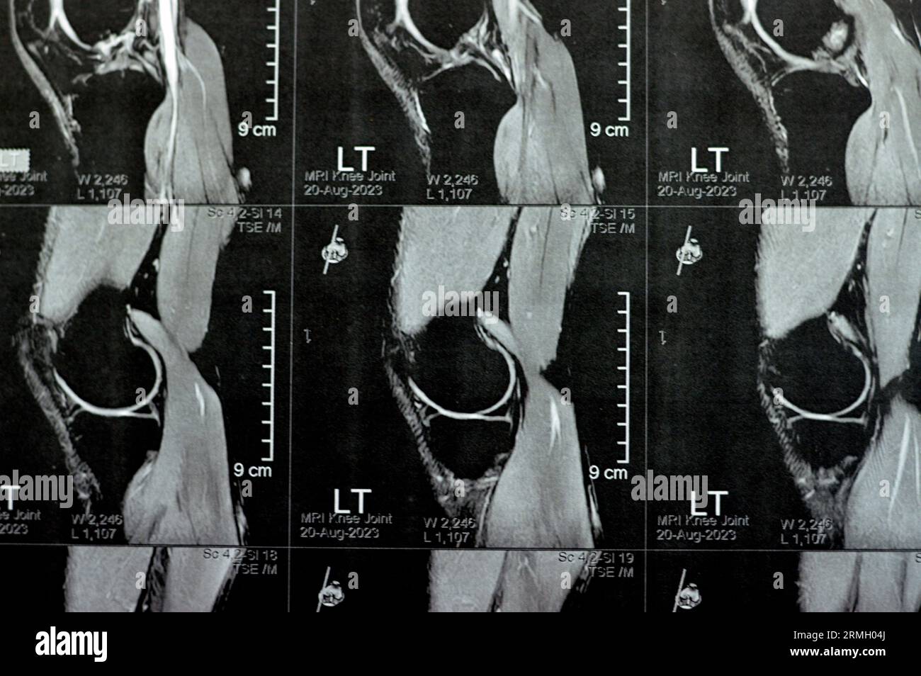 MRI of left knee joint showing minimal joint effusion, PHMM Posterior ...