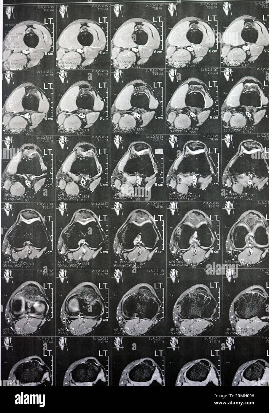 MRI of left knee joint showing minimal joint effusion, PHMM Posterior ...