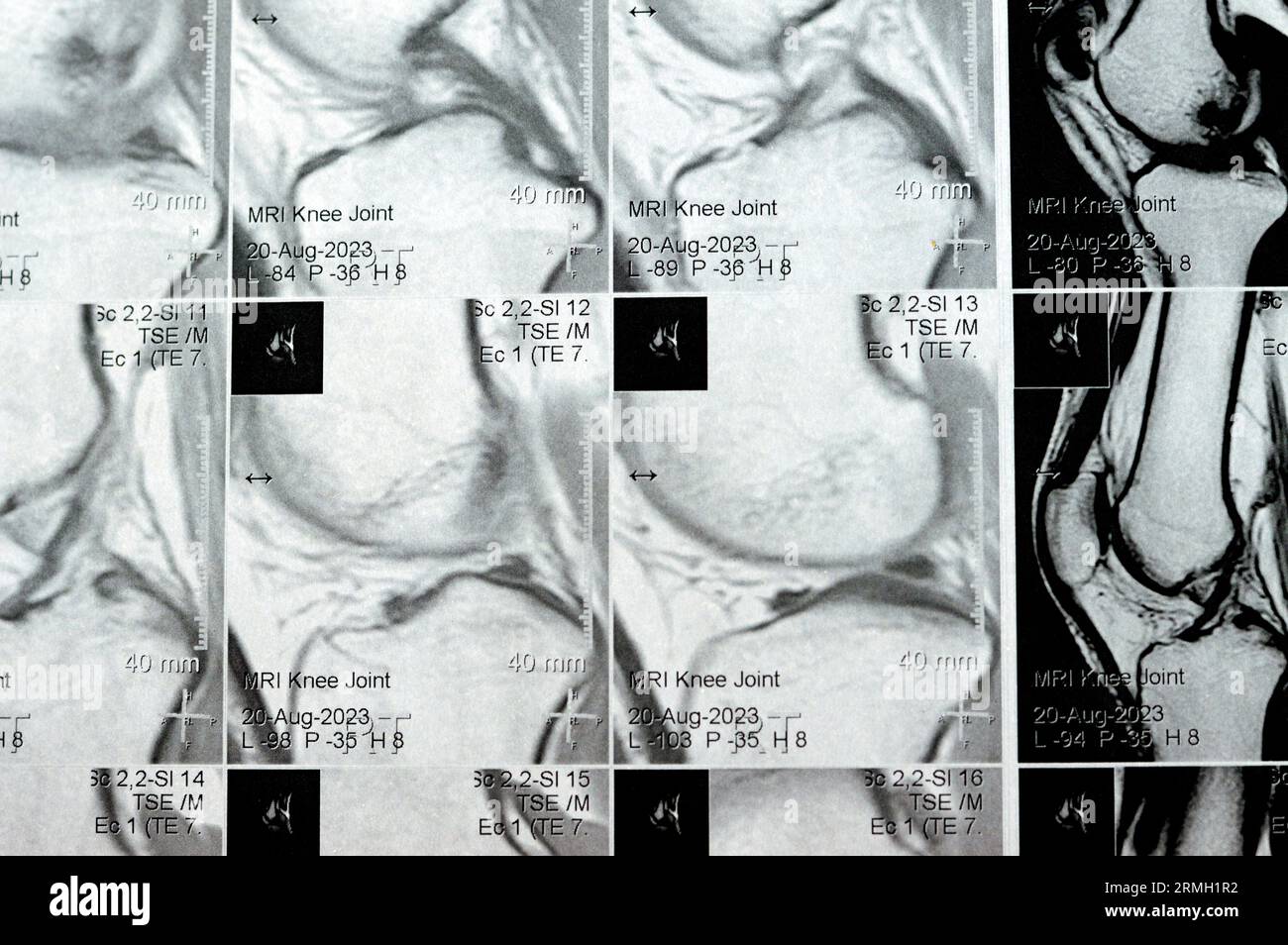 MRI of the right knee showing mild joint effusion, with normal other findings of PHMM, ACL, MCL ...