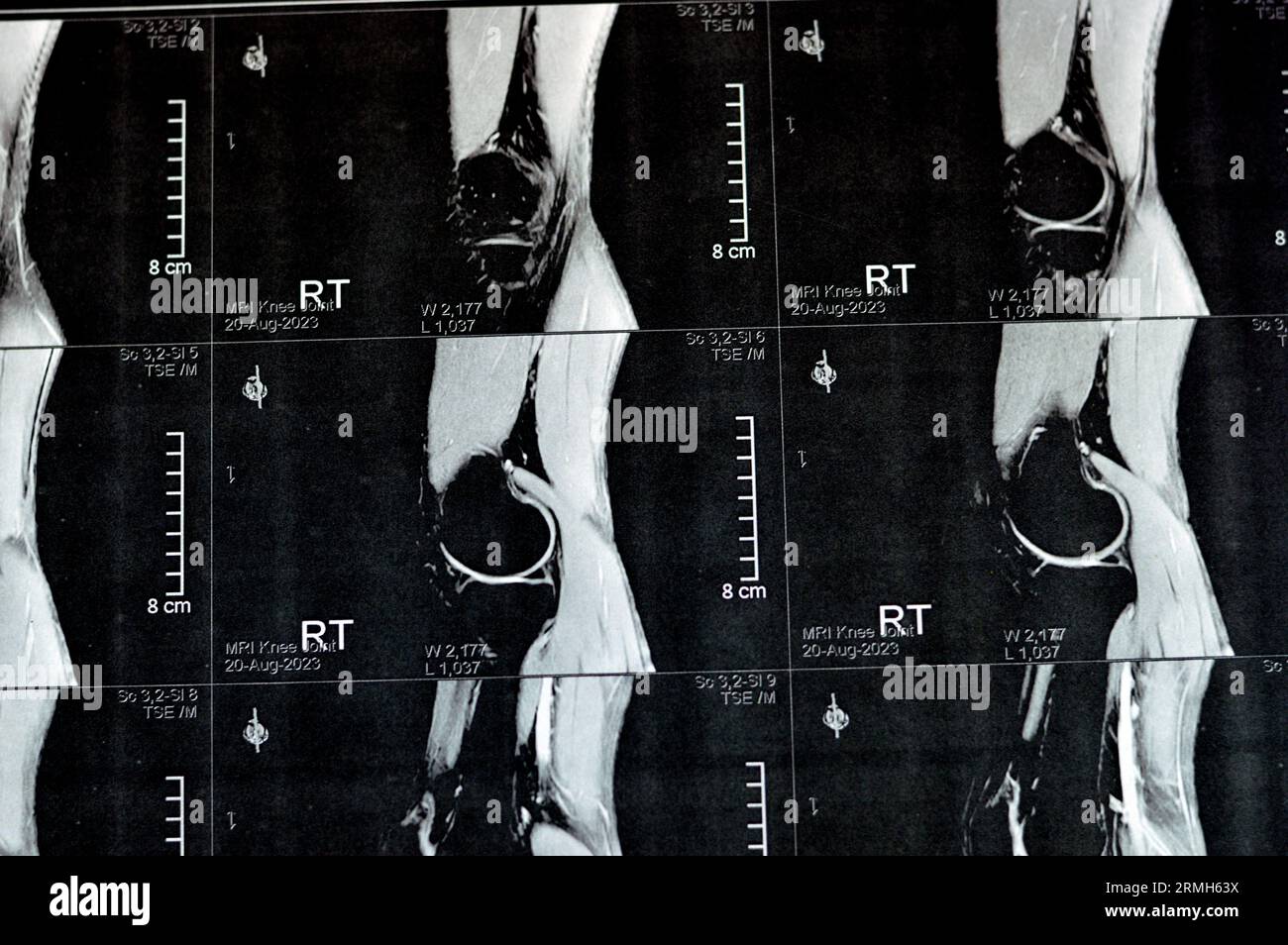 Mri right knee showing hi-res stock photography and images - Alamy