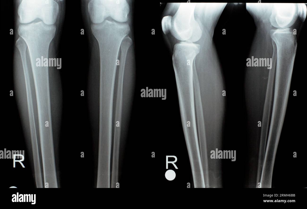 Plain X ray of both right and left knee joints with lower part of femur ...