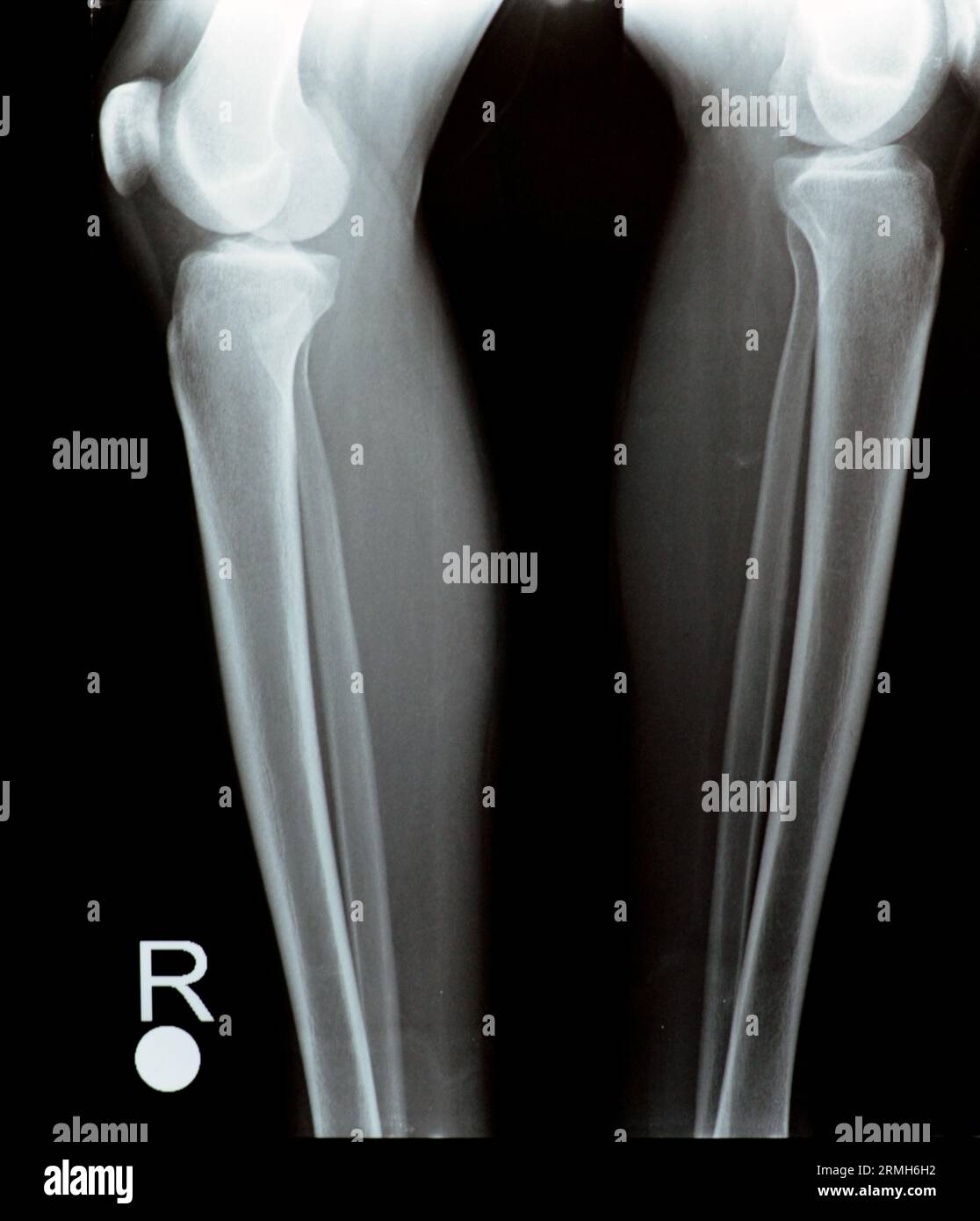 Plain X ray of both right and left knee joints with lower part of femur ...