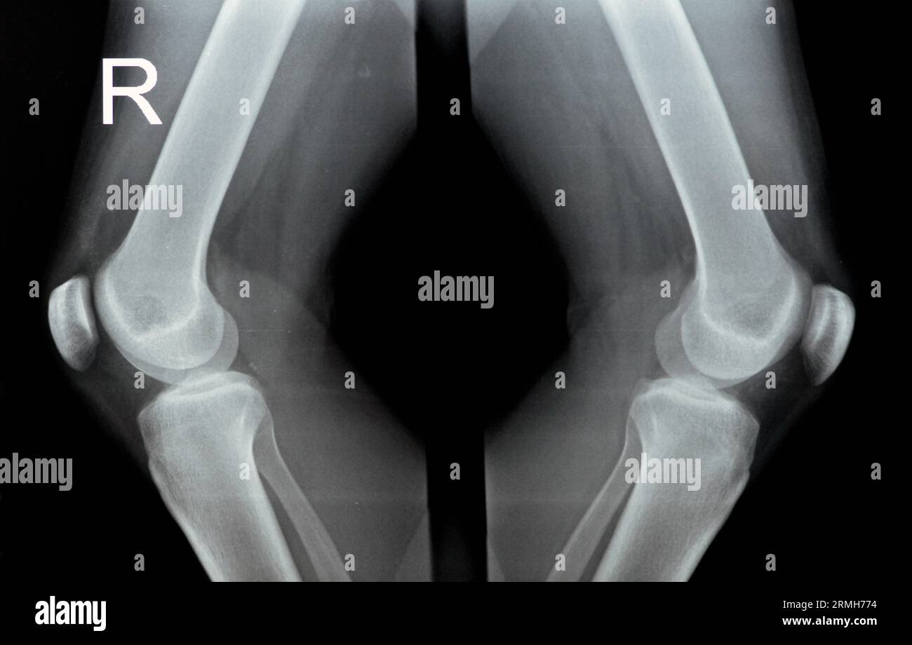 Plain X ray of both right and left knee joints with lower part of femur ...