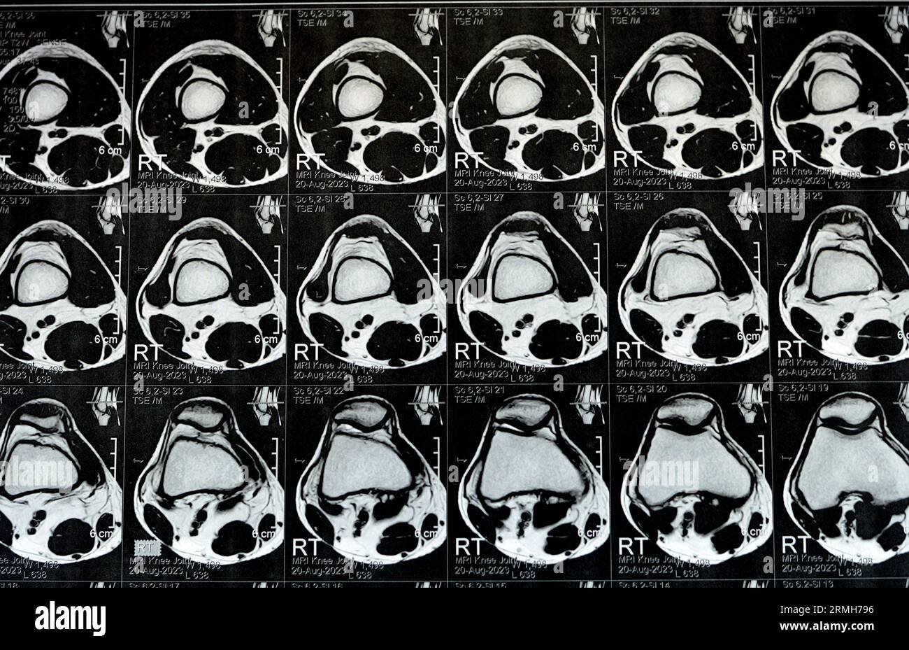 MRI of the right knee showing mild joint effusion, with normal other ...