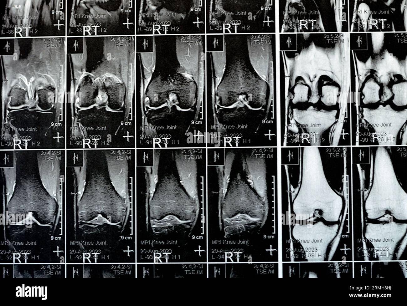 MRI of the right knee showing mild joint effusion, with normal other ...