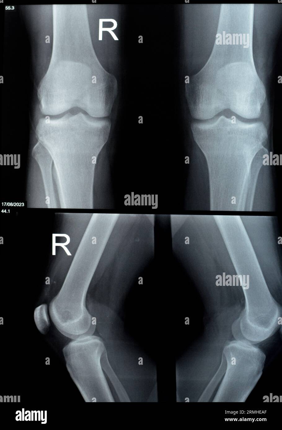 Plain X ray of both right and left knee joints with lower part of femur ...