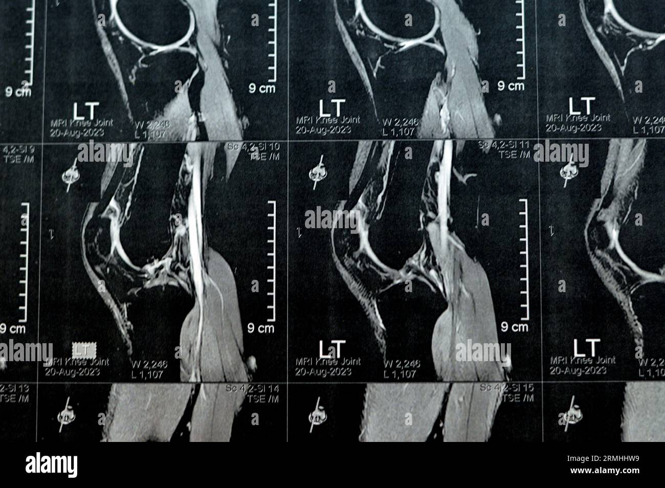 MRI of left knee joint showing minimal joint effusion, PHMM Posterior ...