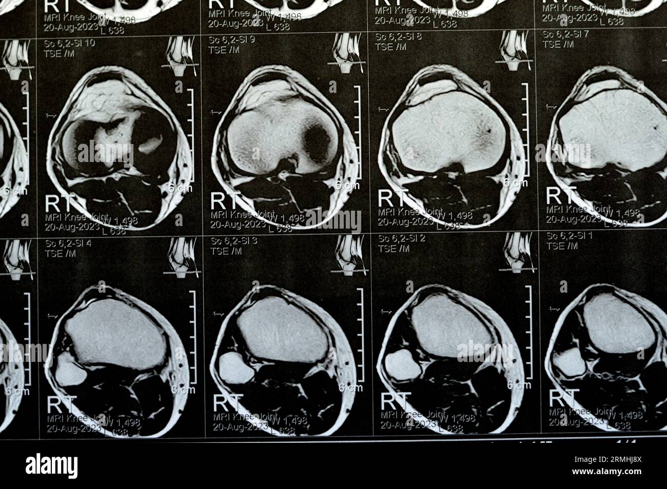 MRI of the right knee showing mild joint effusion, with normal other ...