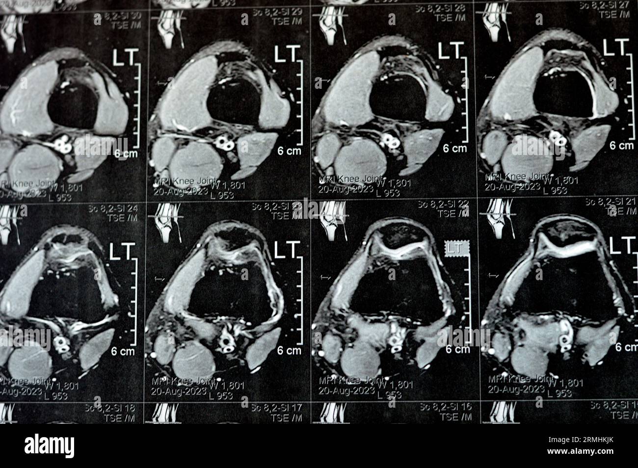 MRI of left knee joint showing minimal joint effusion, PHMM Posterior ...