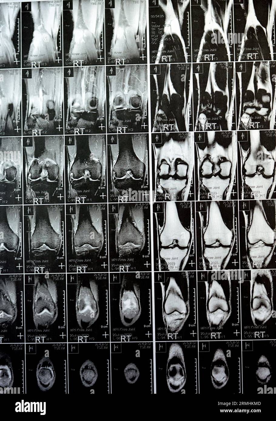 MRI of the right knee showing mild joint effusion, with normal other ...