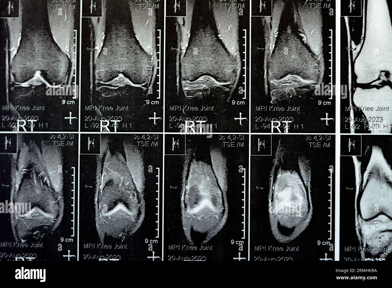 MRI of the right knee showing mild joint effusion, with normal other ...