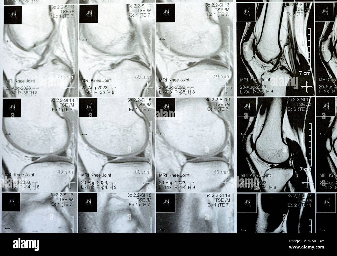 MRI of the right knee showing mild joint effusion, with normal other ...