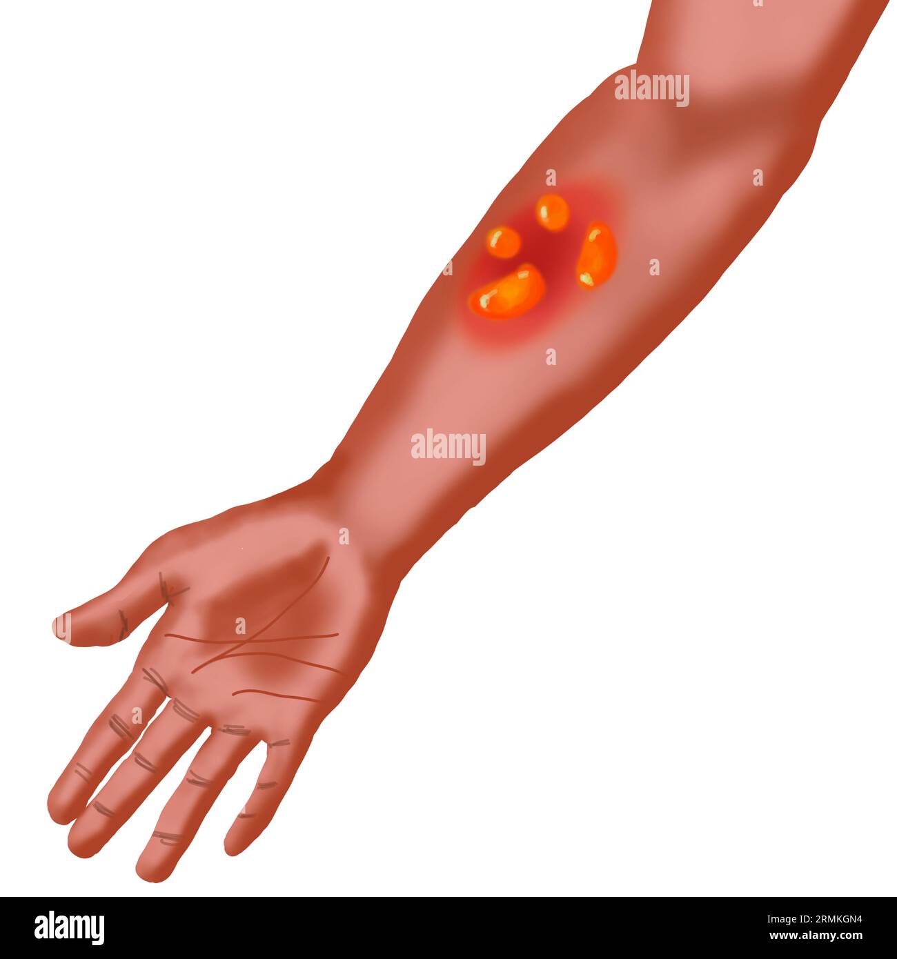 bullous pemphigoid 3D illustration Stock Photo - Alamy