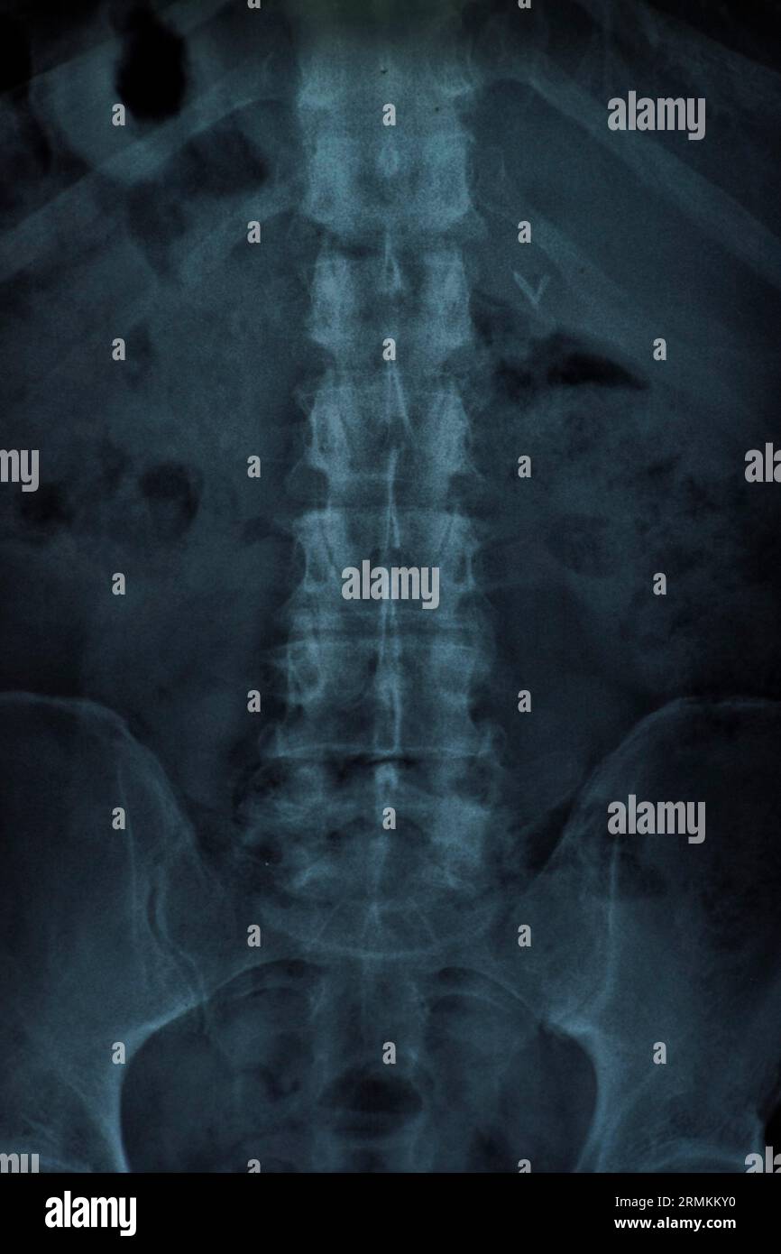 X ray vertebral column Stock Photo - Alamy