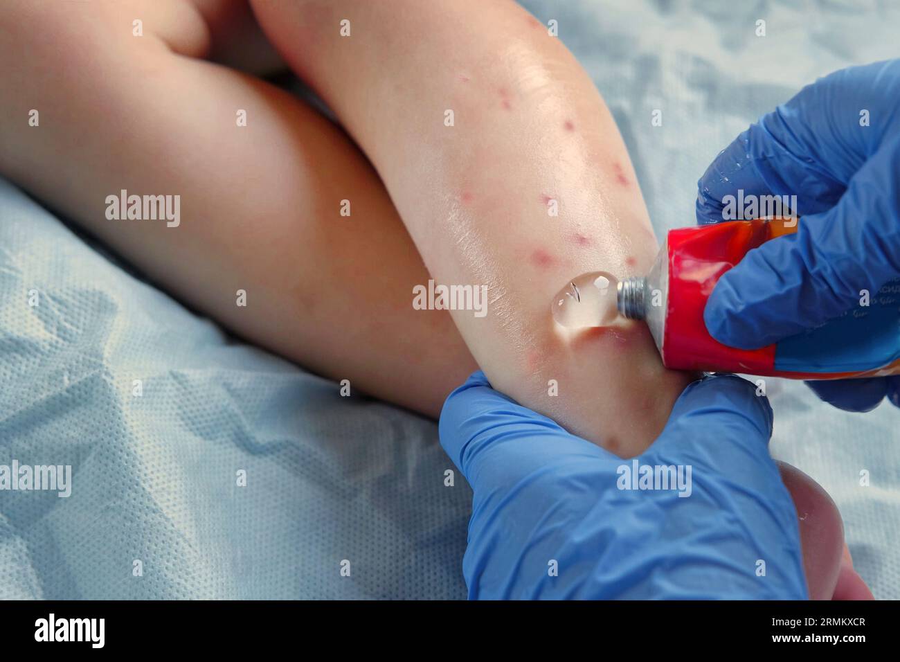 Doctor hands examining infant leg. Little Kid allergy. Closeup. Child ...