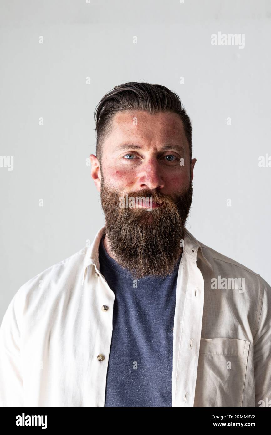 Young caucasian male suffering from rosacea, couperose. Redness of the ...