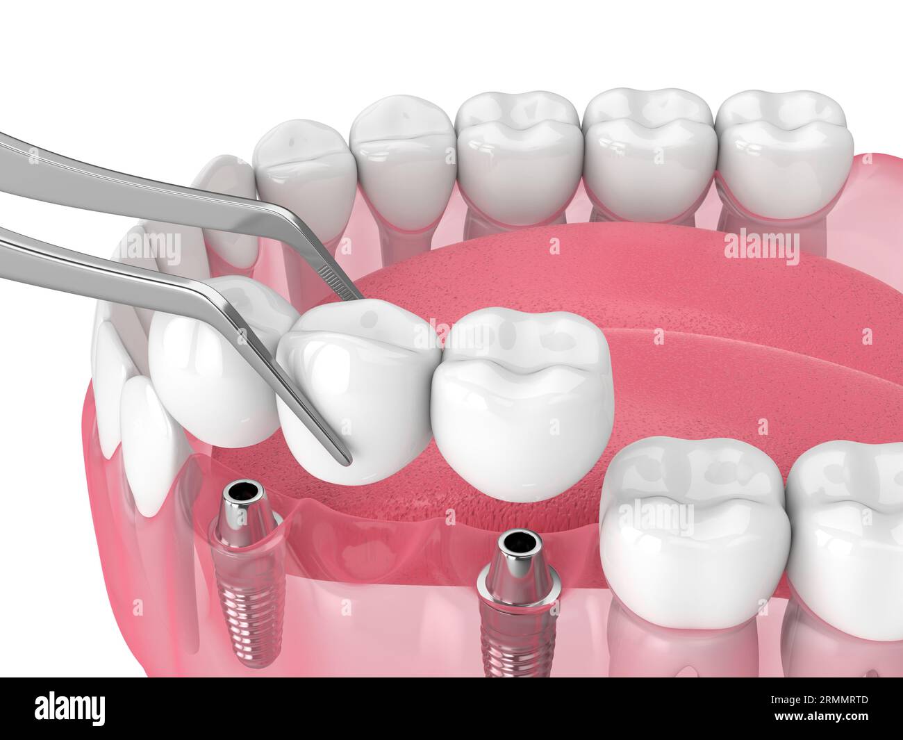 Jaw with implants supporting dental bridge over white background Stock ...