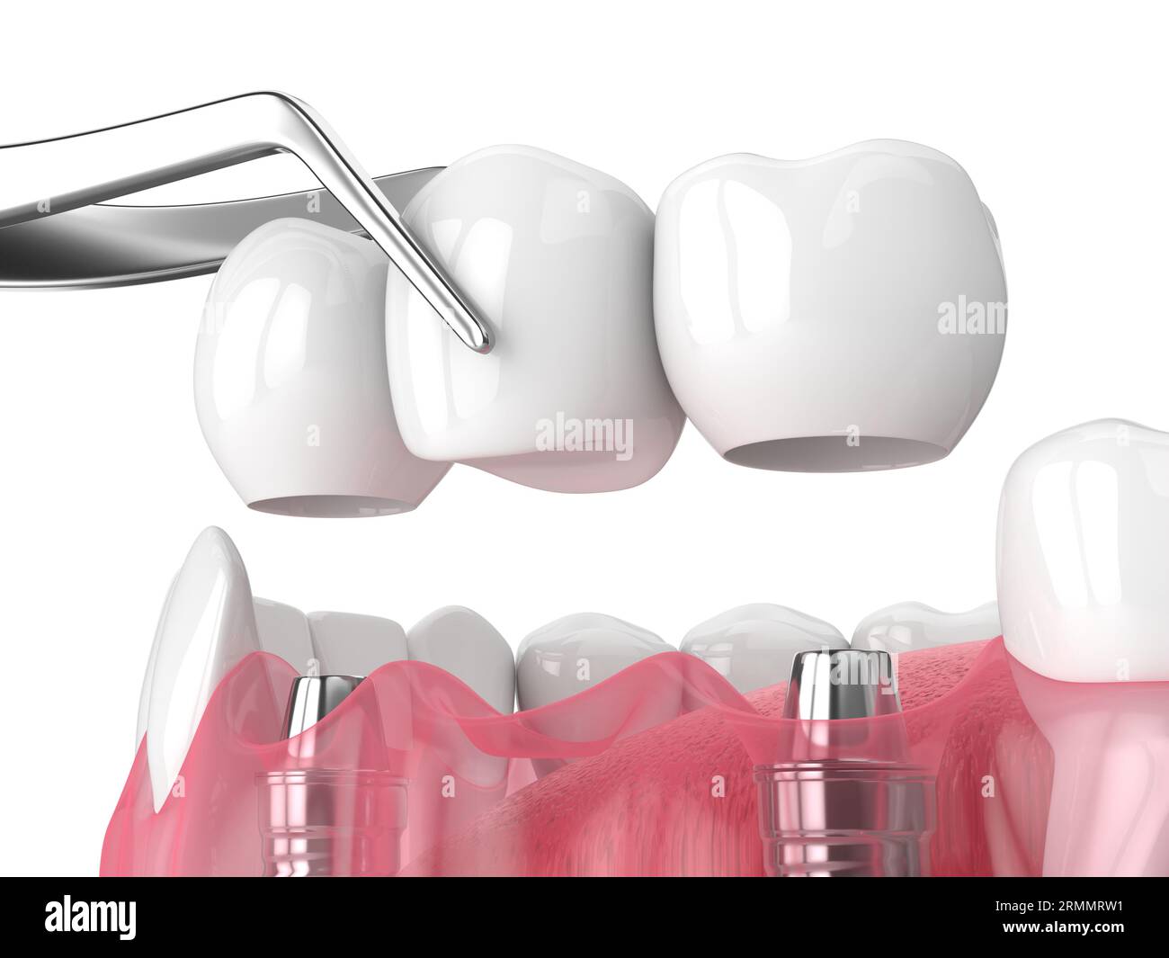 Jaw with implants supporting dental bridge over white background Stock ...