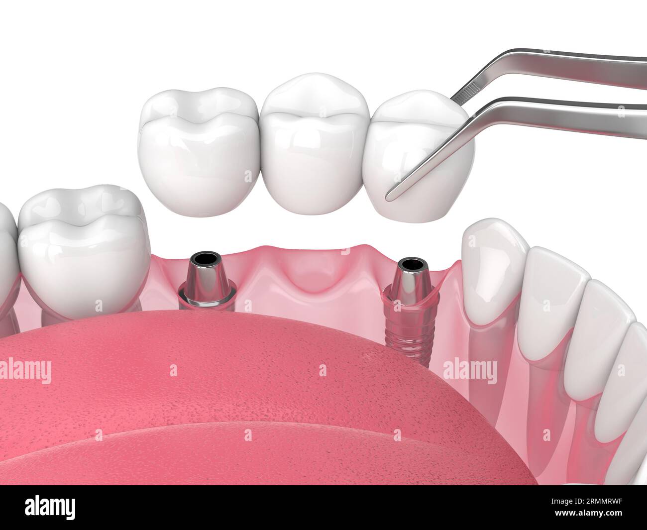 Jaw with implants supporting dental bridge over white background Stock ...