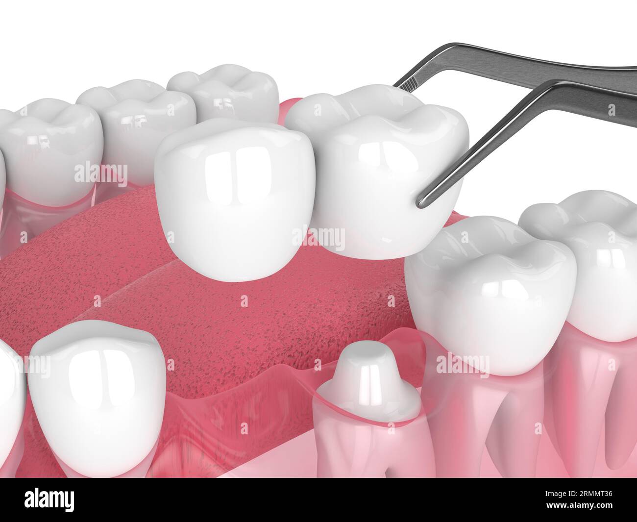 3d render of jaw with dental cantilever bridge on embedded tooth over ...