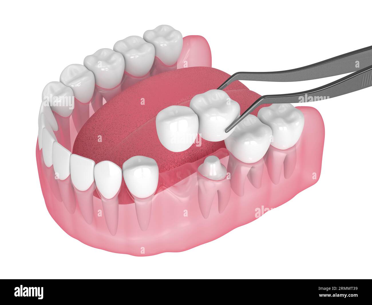 3d render of jaw with dental cantilever bridge on embedded tooth over ...