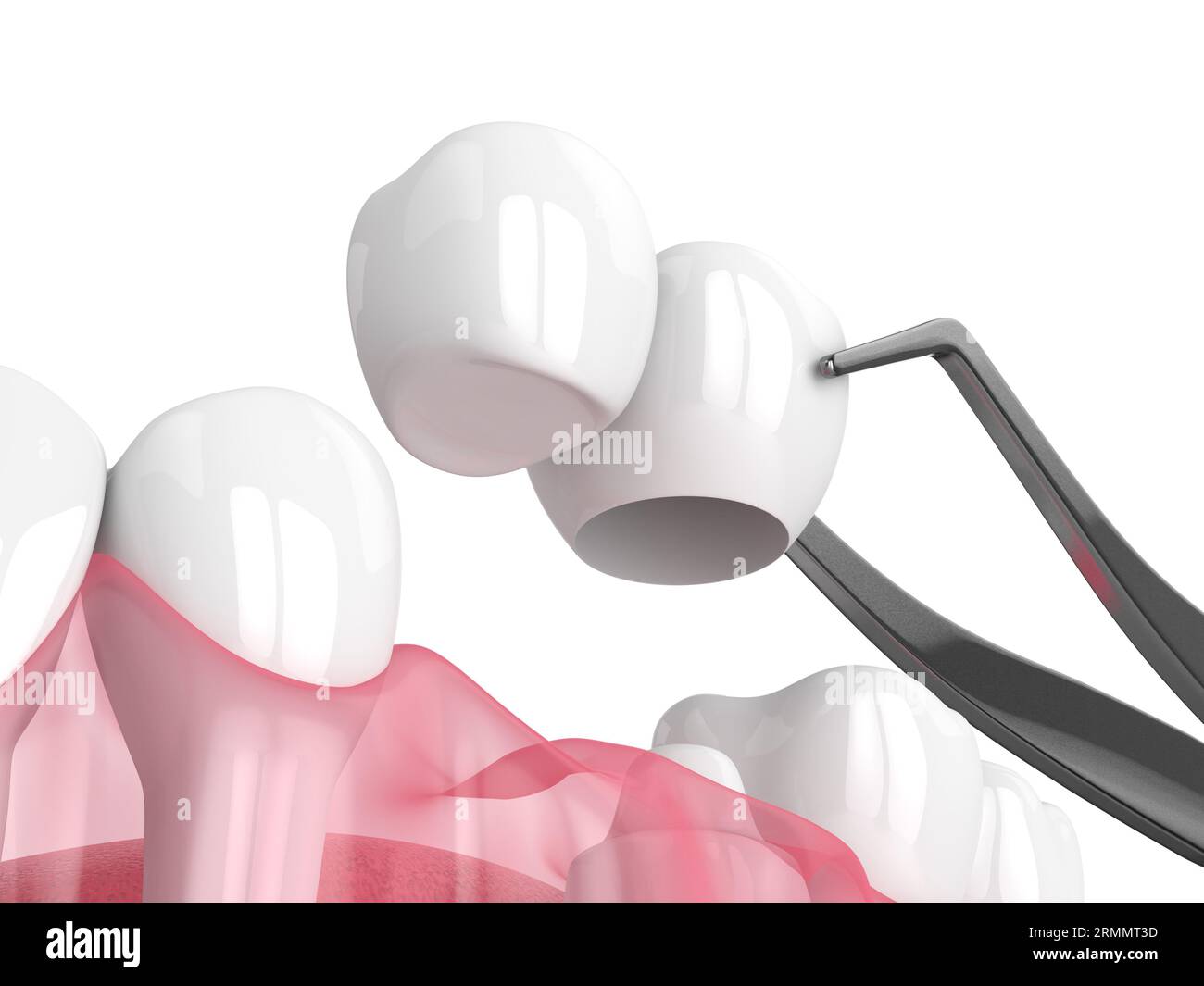 3d render of jaw with dental cantilever bridge on embedded tooth over ...