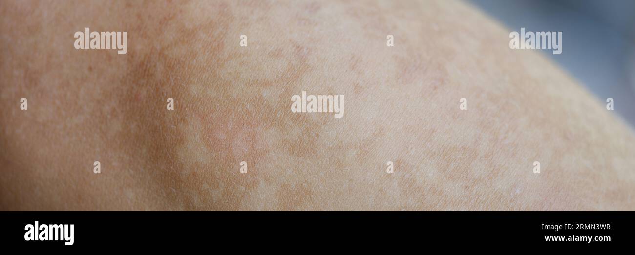 Macro part of the body is uneven pigmentation skin Stock Photo - Alamy