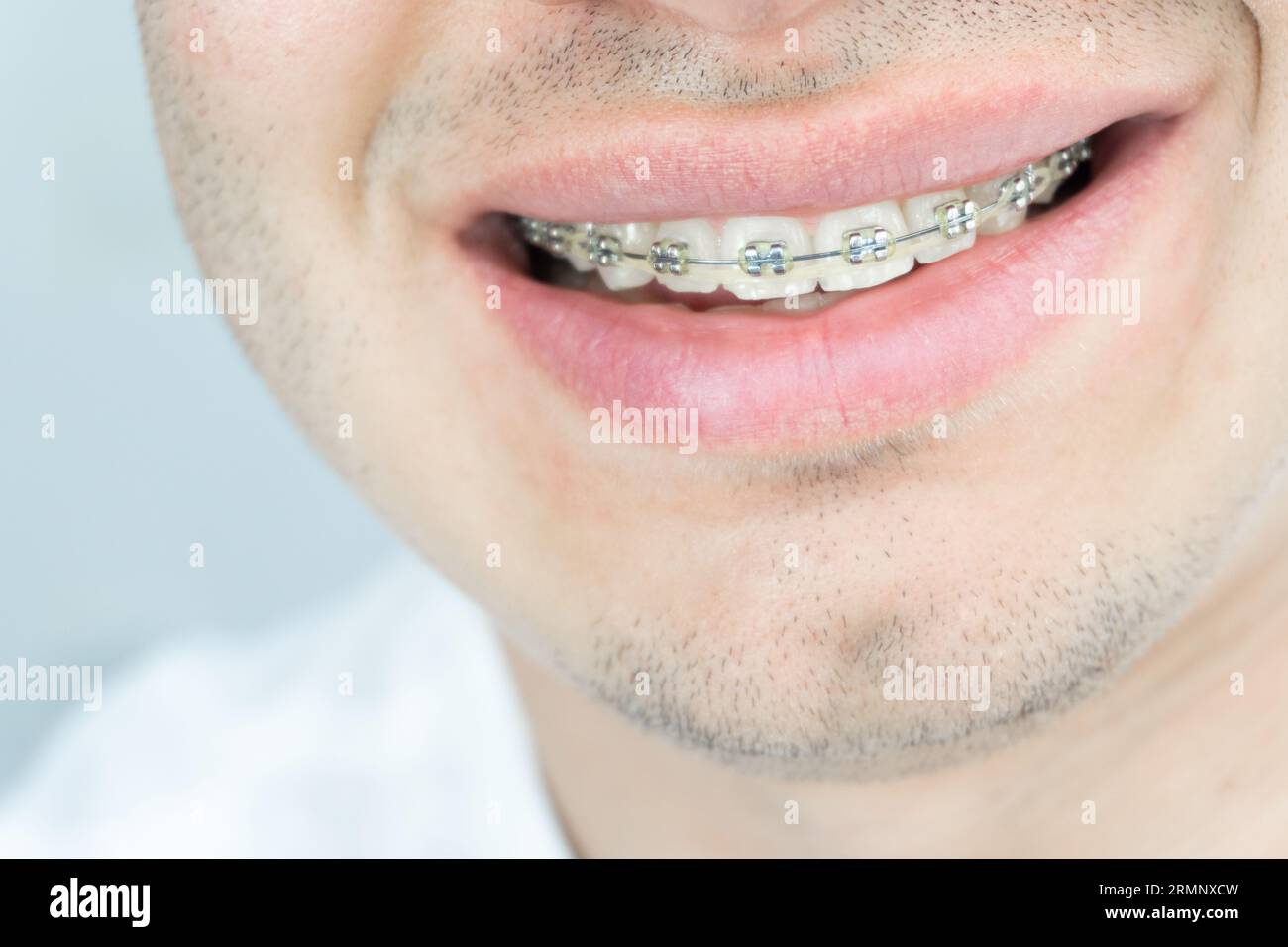 White Bracket Braces