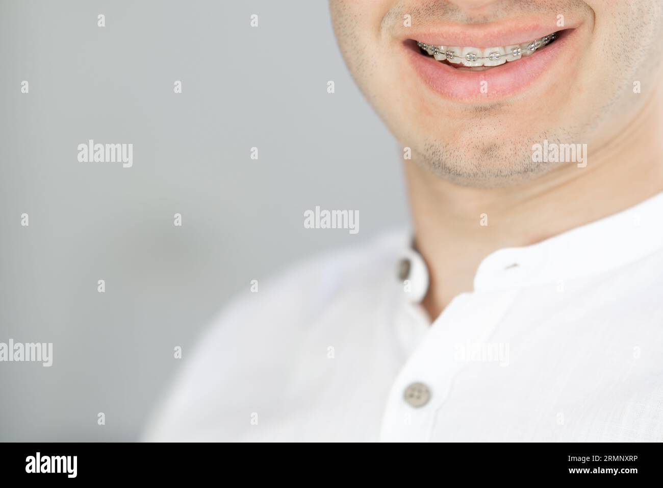 Close up of the smile of a handsome young man with braces smiling with ...